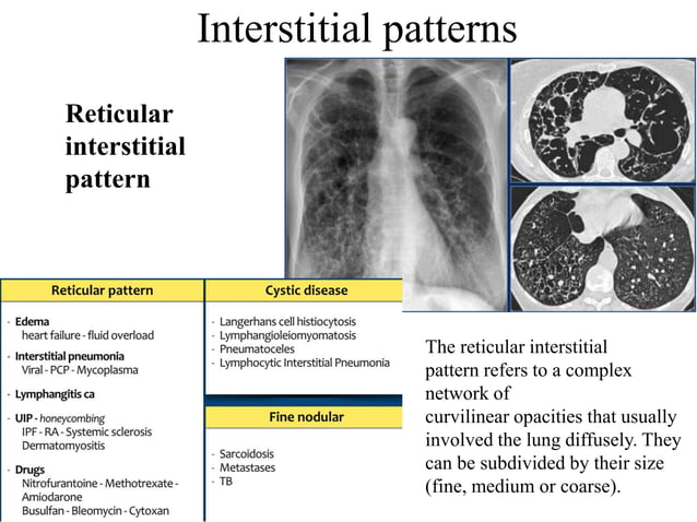 Chest X-ray patterns | PPT