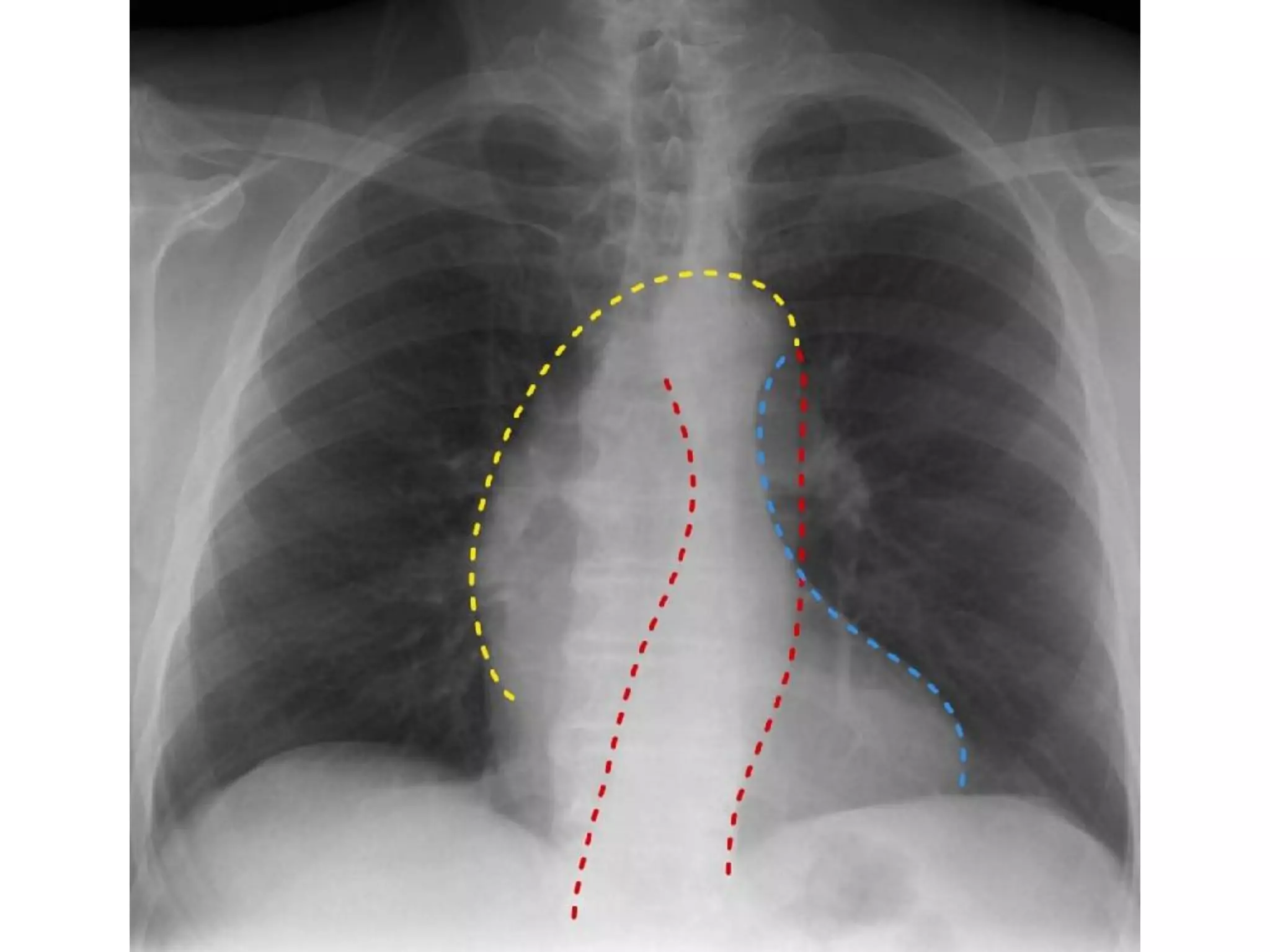 Chest film in cardiovascular system | PPT