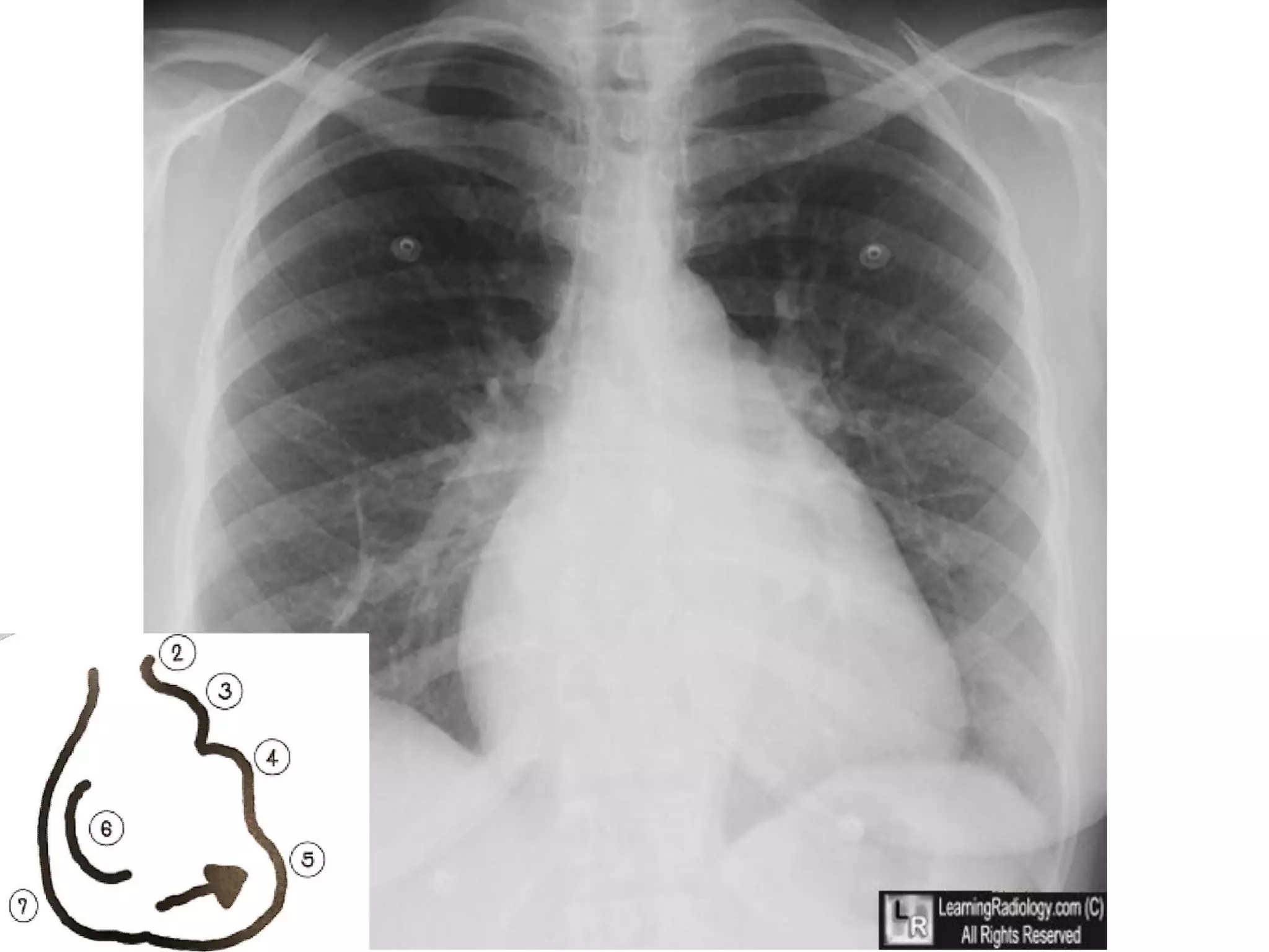 Chest film in cardiovascular system | PPT