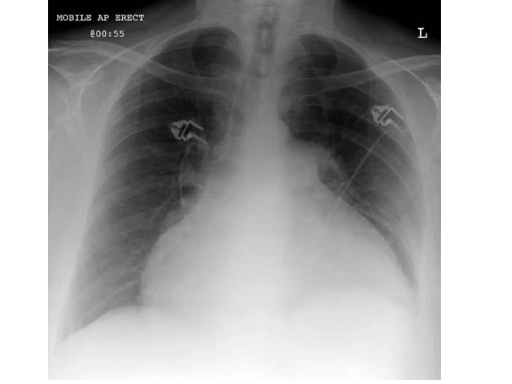 Chest film in cardiovascular system | PPT