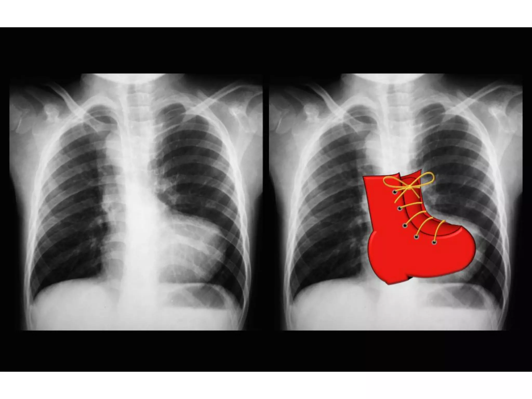 Chest film in cardiovascular system | PPT