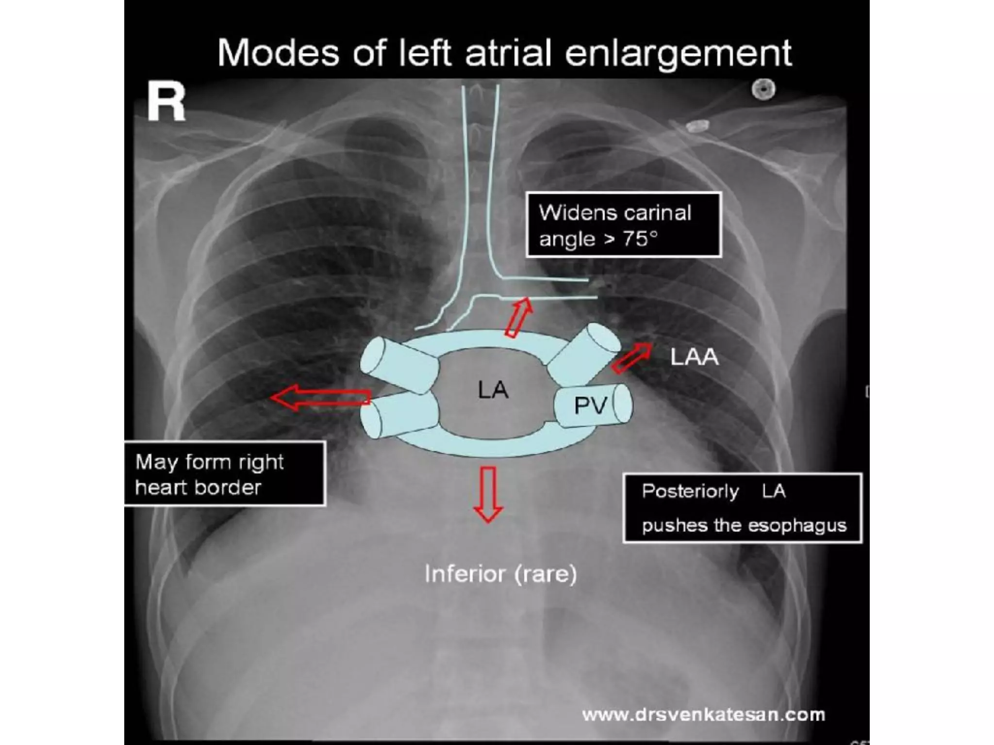 Chest film in cardiovascular system | PPT