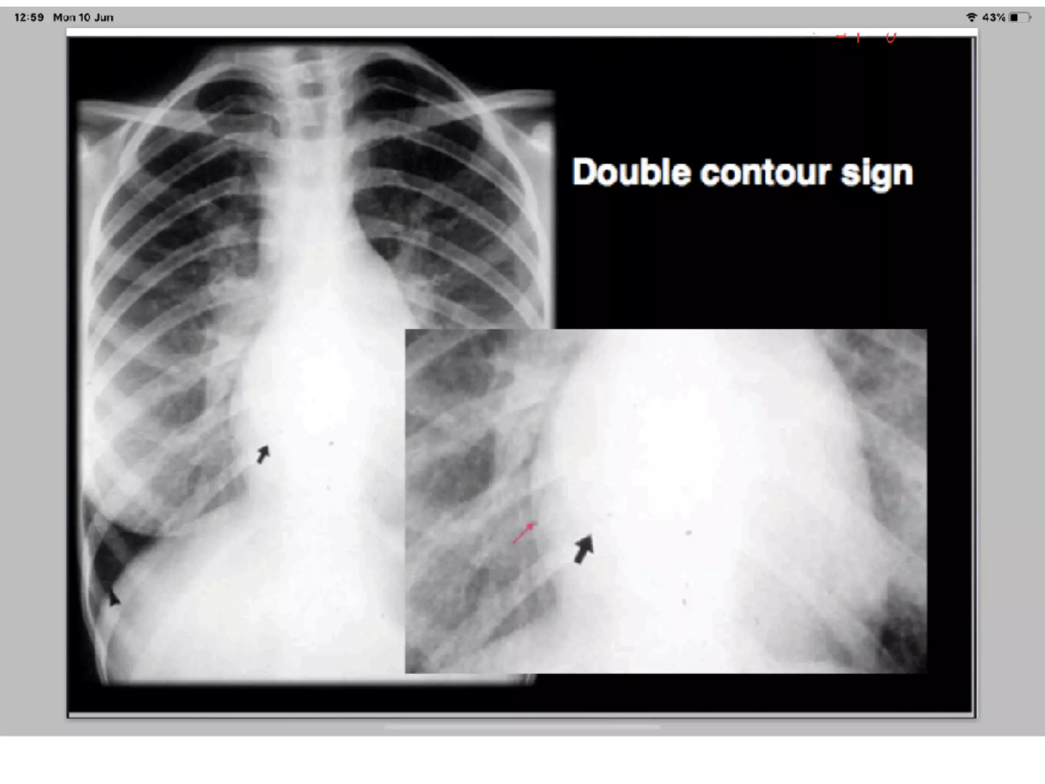 Chest film in cardiovascular system | PDF
