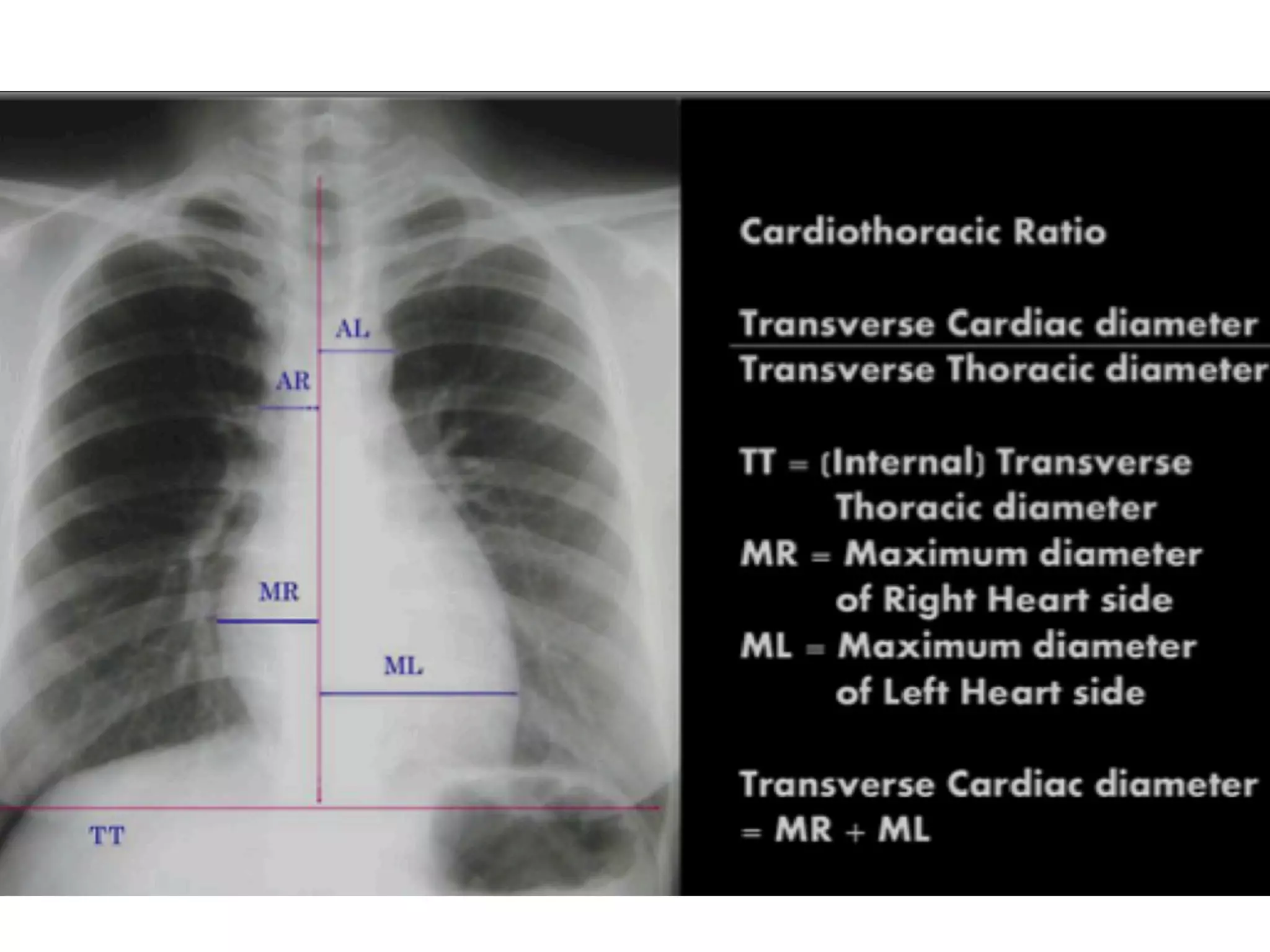 Chest film in cardiovascular system | PPT