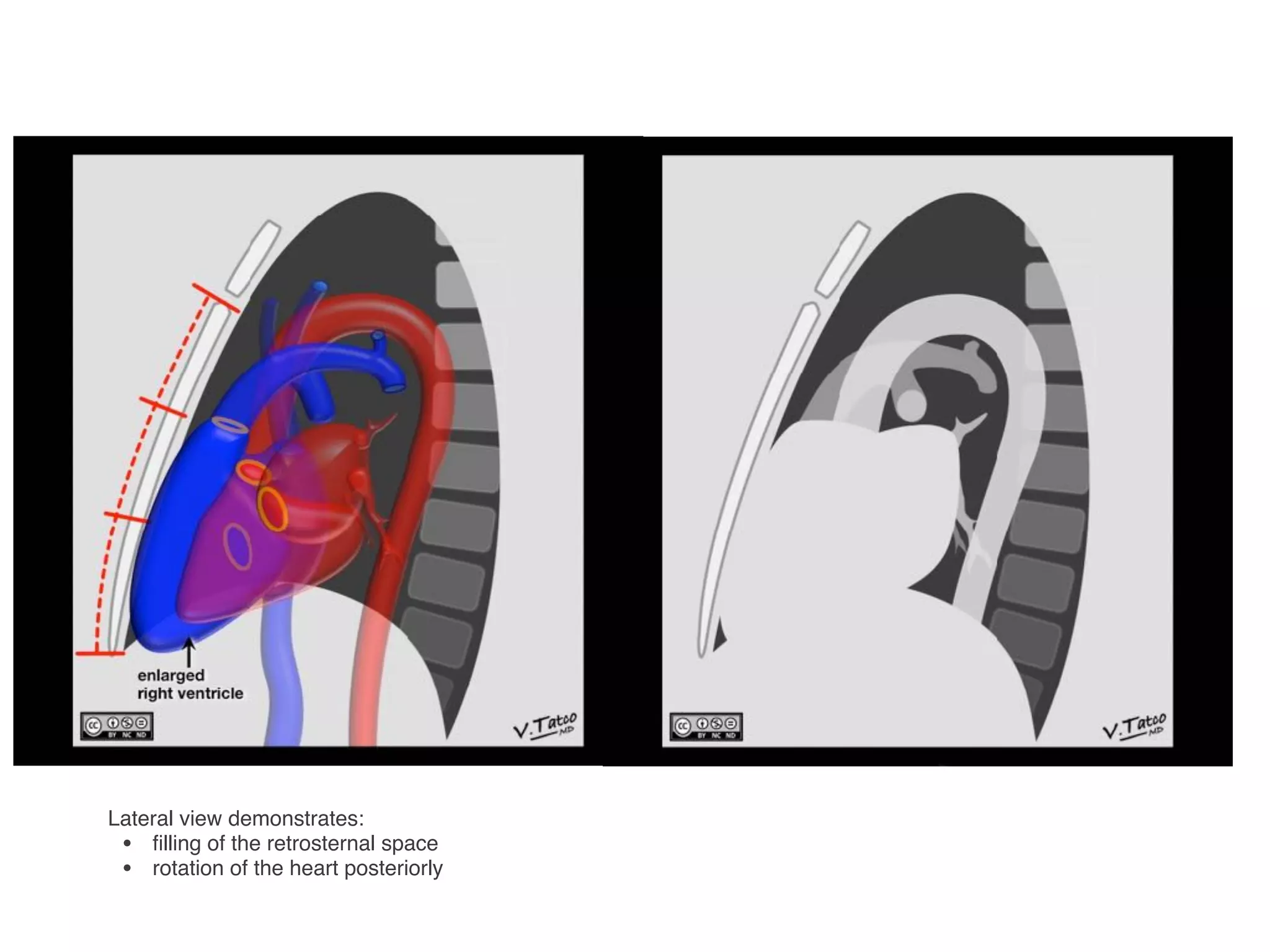 Chest film in cardiovascular system | PDF