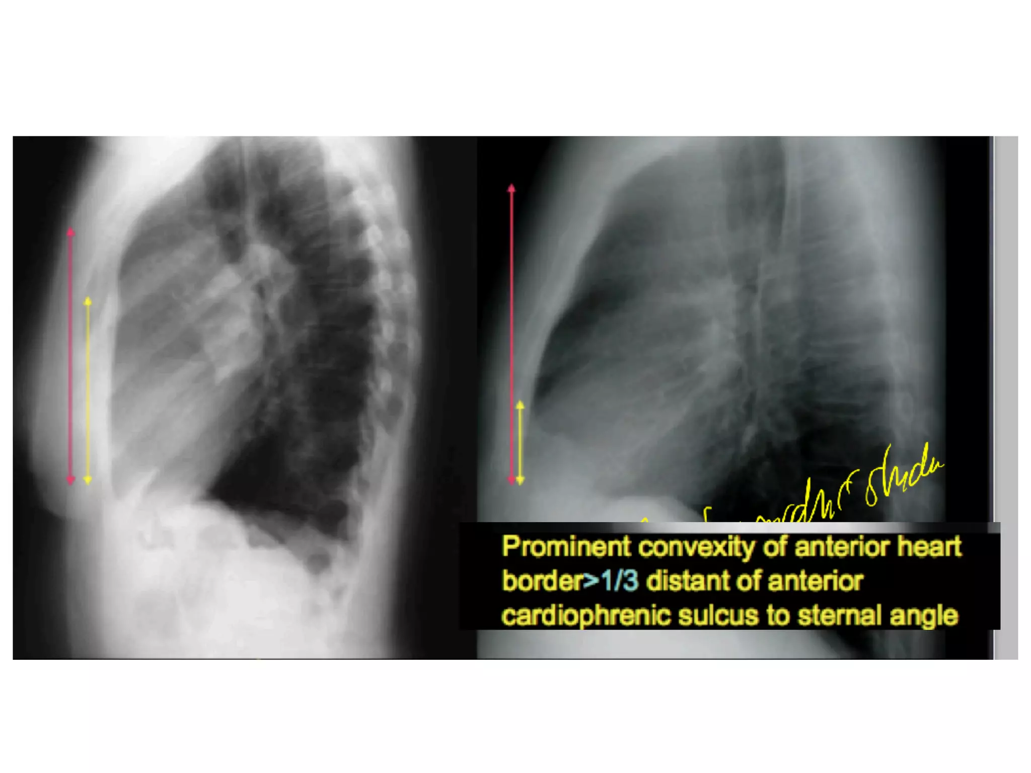 Chest film in cardiovascular system | PDF
