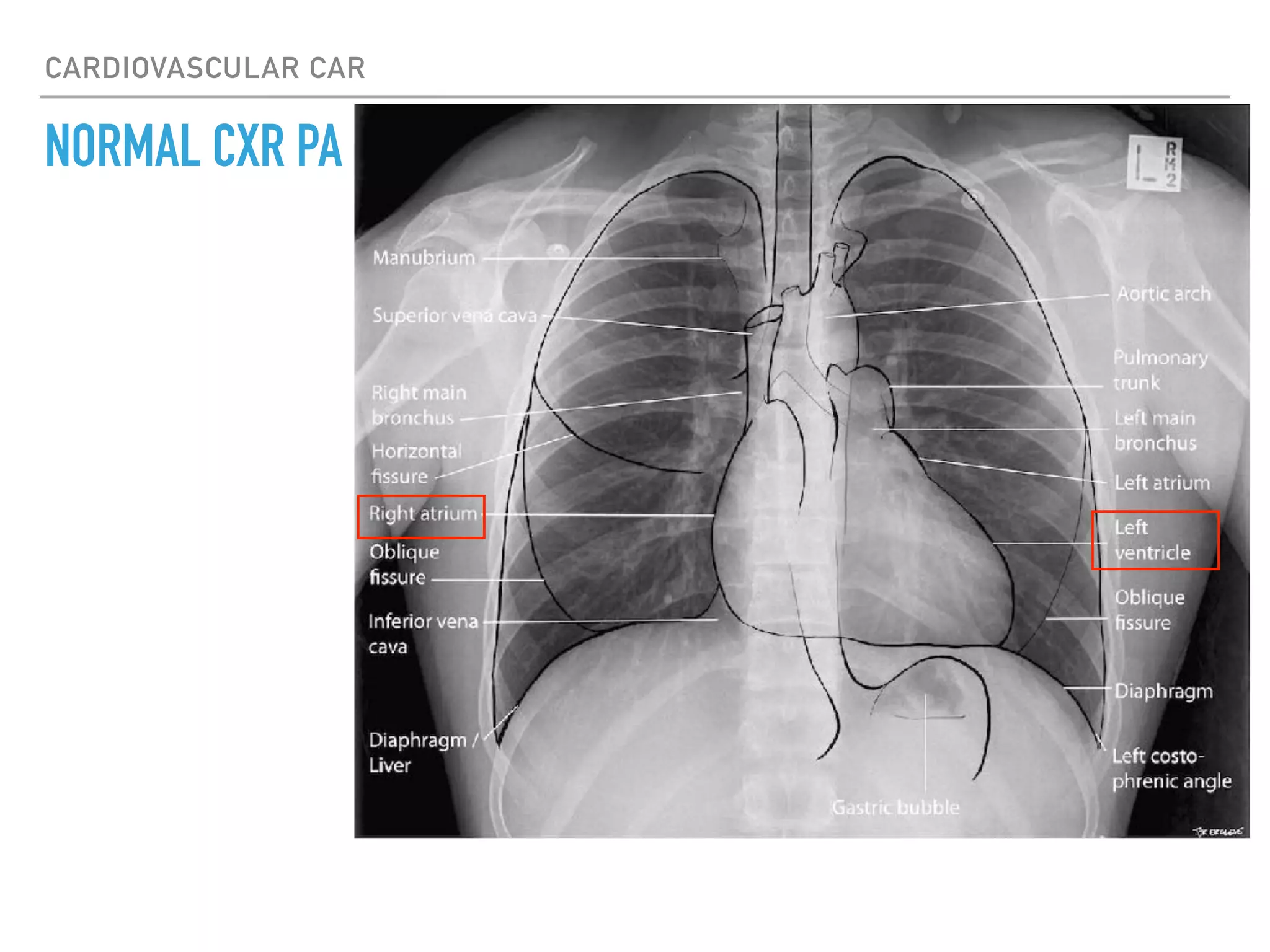 Chest film in cardiovascular system | PPT