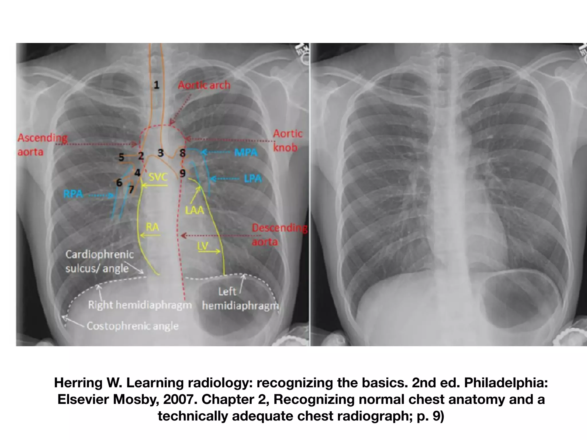 Chest film in cardiovascular system | PPT