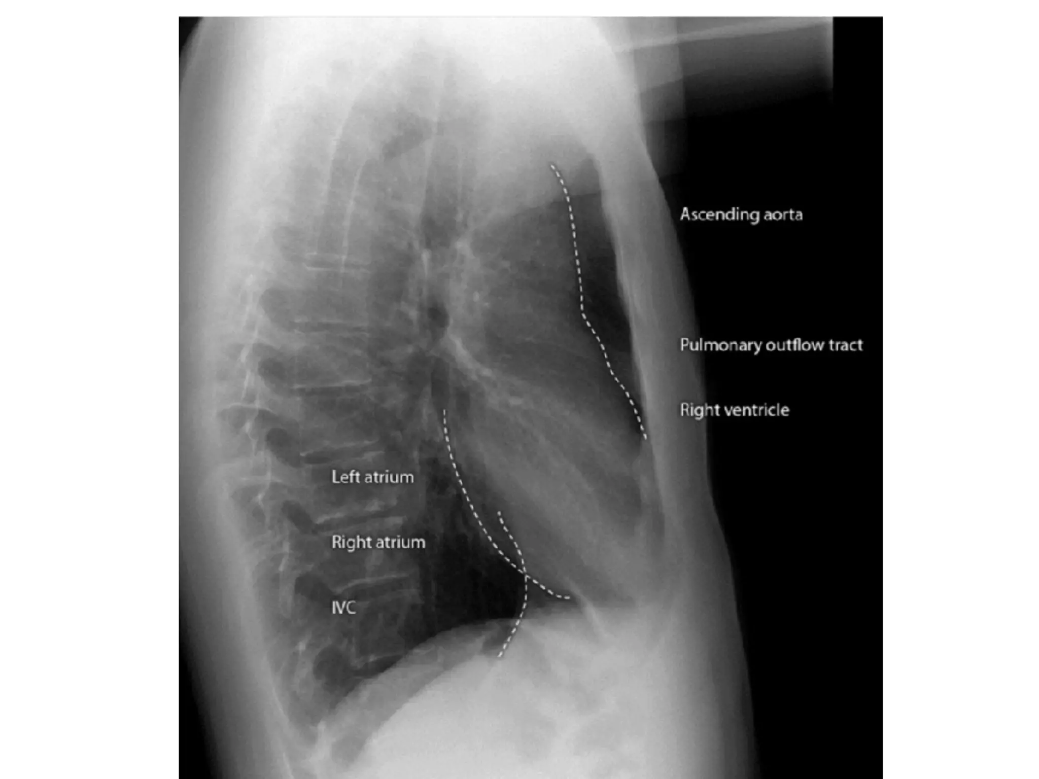 Chest film in cardiovascular system | PPT