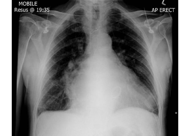 Chest film in cardiovascular system | PPT