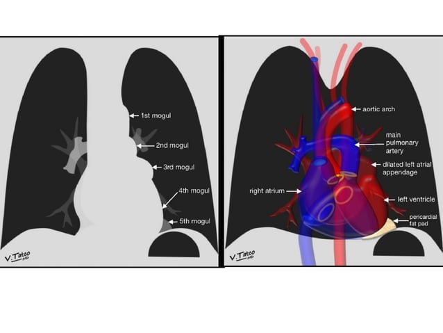 Chest film in cardiovascular system | PPT