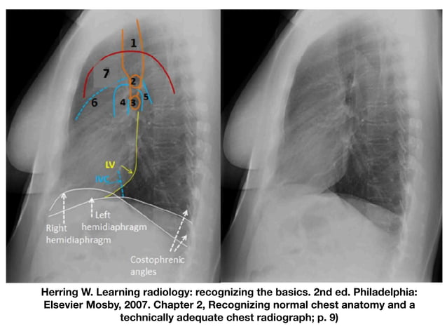 Chest film in cardiovascular system | PPT