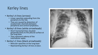 CXR Presentation.pptx
