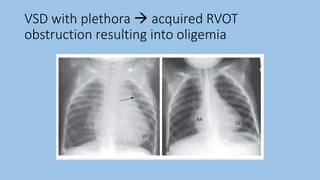 CXR Presentation.pptx