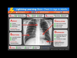 Chest X Ray Primer notes signs and diagnostics.pptx