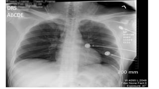 CXR & PXR. in Poly trauma Primary survey | PPTX