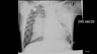 CXR & PXR. in Poly trauma Primary survey | PPTX
