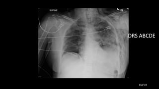 CXR & PXR. in Poly trauma Primary survey | PPTX