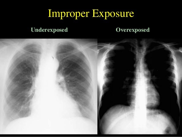 Cxr revised 24 11-91