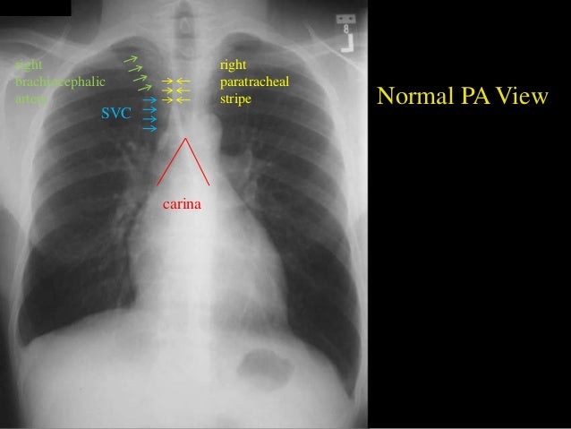 Cxr revised 24 11-91
