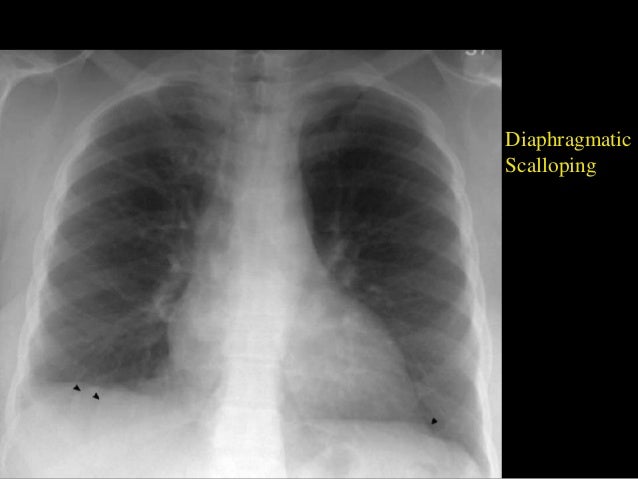 Cxr revised 24 11-91