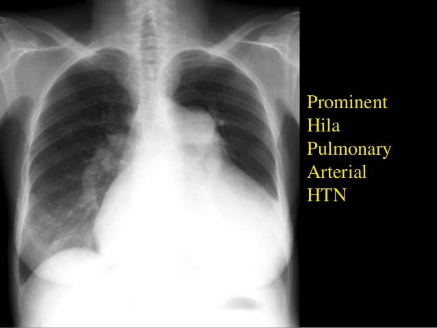Cxr revised 24 11-91