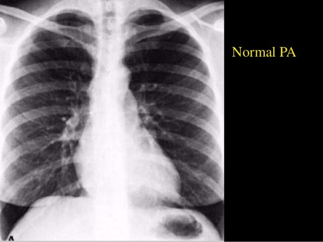 Costochondral Calcification