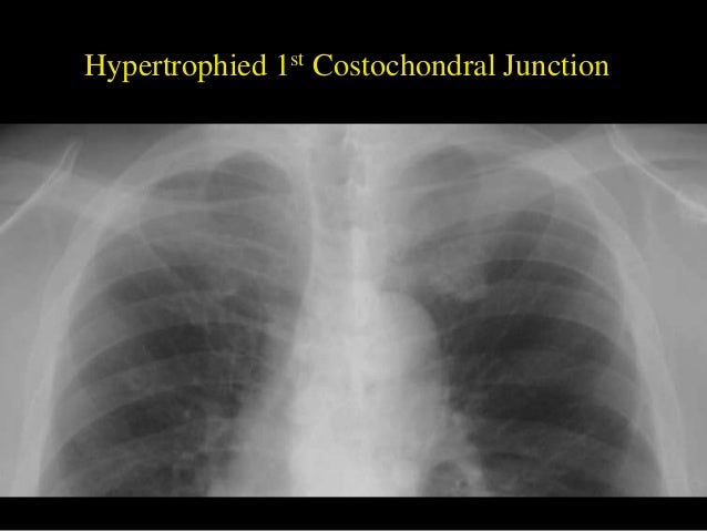 Enlarged Costochondral Junction