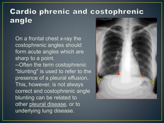 Chest x ray - basics | PPTX