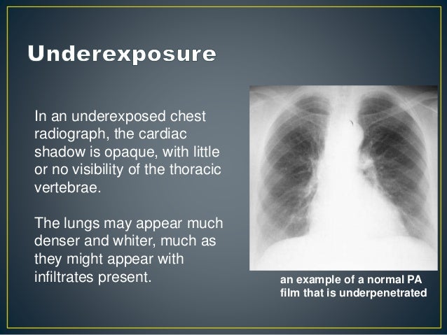 Chest x ray - basics