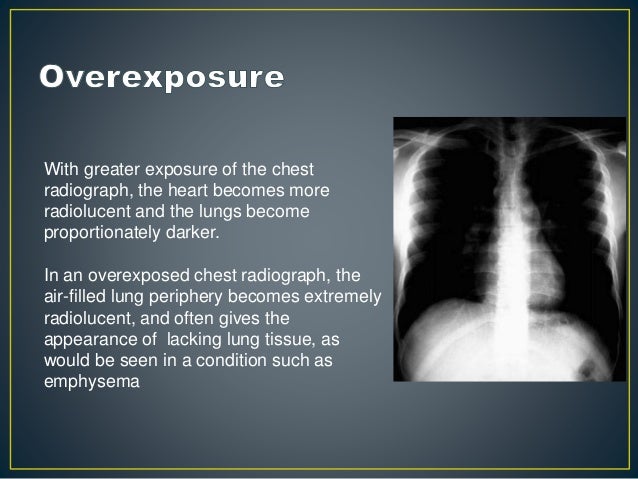 Chest x ray - basics