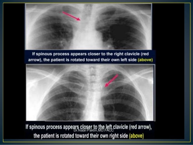 Chest x ray - basics