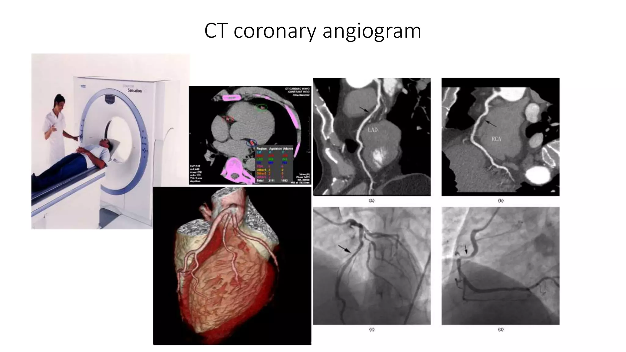 CT Coronary Angiogram VS Cardiac Stress Test | PPTX