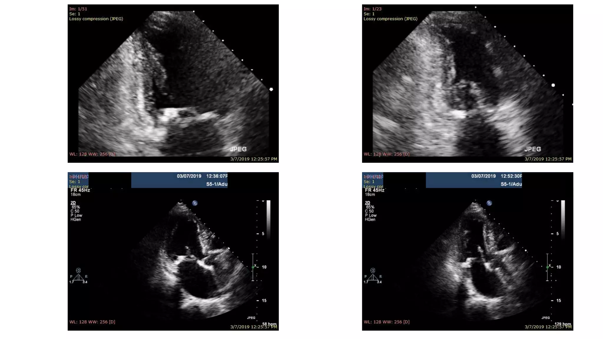 CT Coronary Angiogram VS Cardiac Stress Test | PPTX