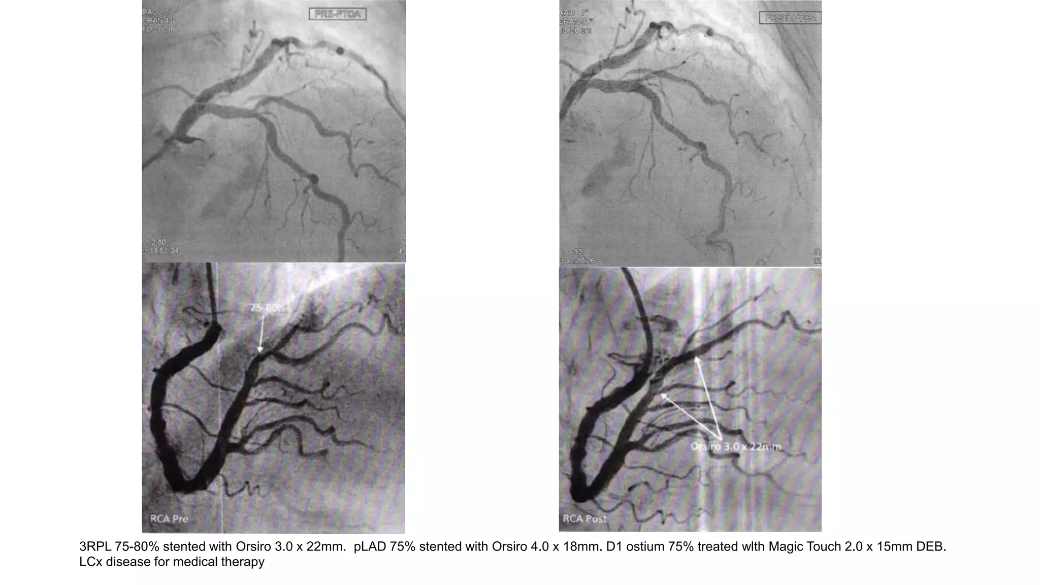 CT Coronary Angiogram VS Cardiac Stress Test | PPTX