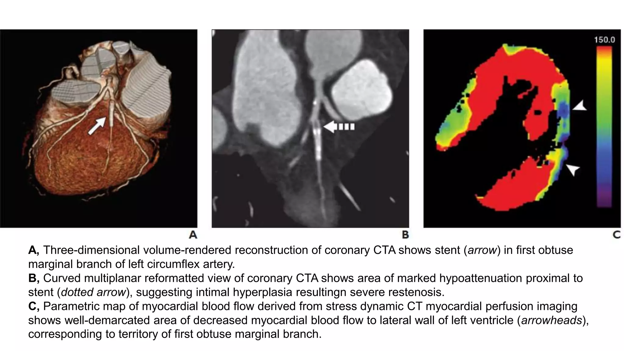 CT Coronary Angiogram VS Cardiac Stress Test | PPTX