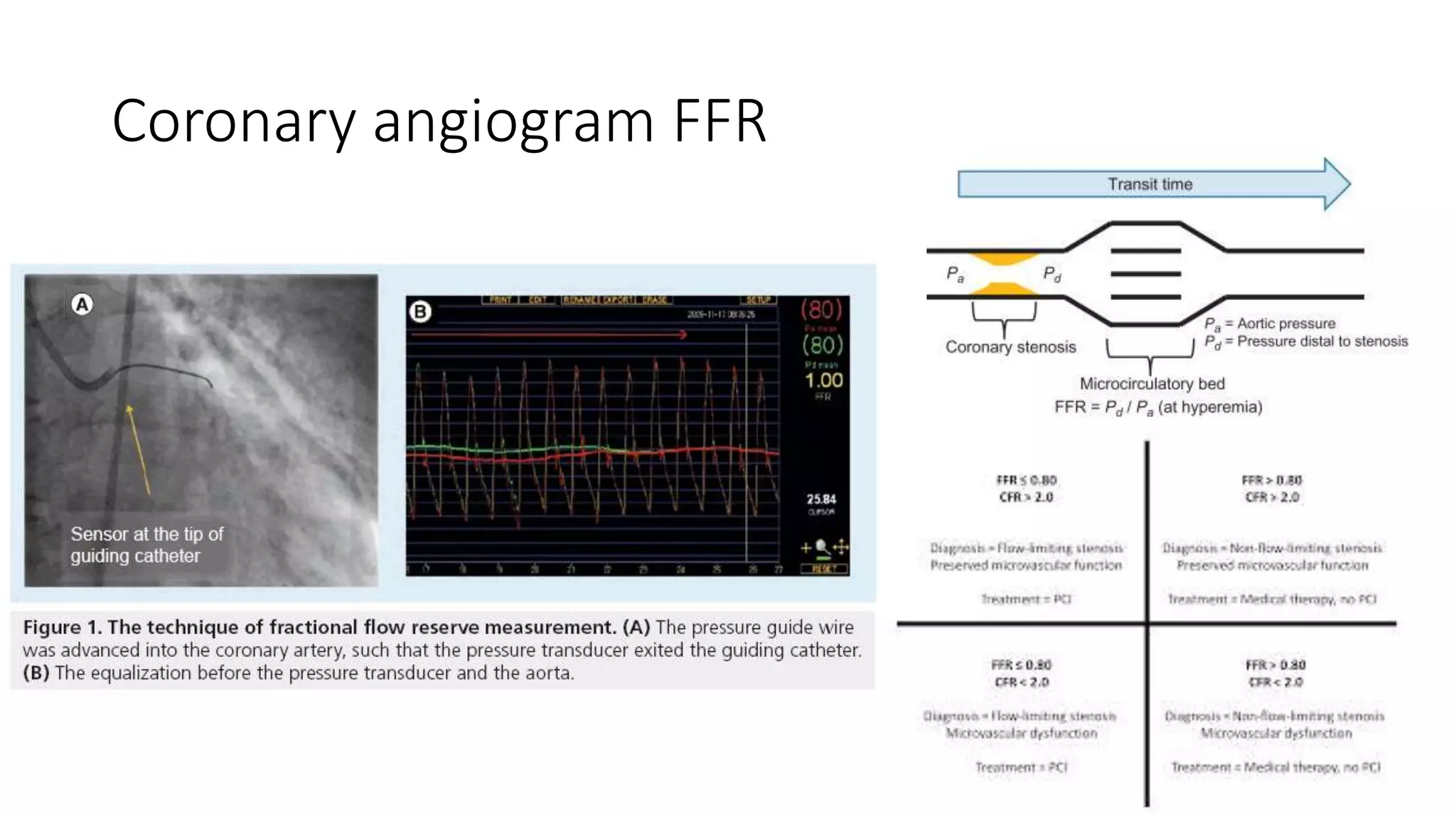 CT Coronary Angiogram VS Cardiac Stress Test | PPTX