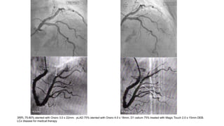 CT Coronary Angiogram VS Cardiac Stress Test | PPTX