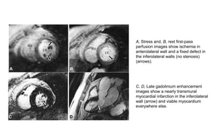 CT Coronary Angiogram VS Cardiac Stress Test | PPTX