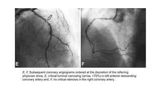 CT Coronary Angiogram VS Cardiac Stress Test | PPTX