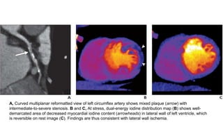 CT Coronary Angiogram VS Cardiac Stress Test | PPTX