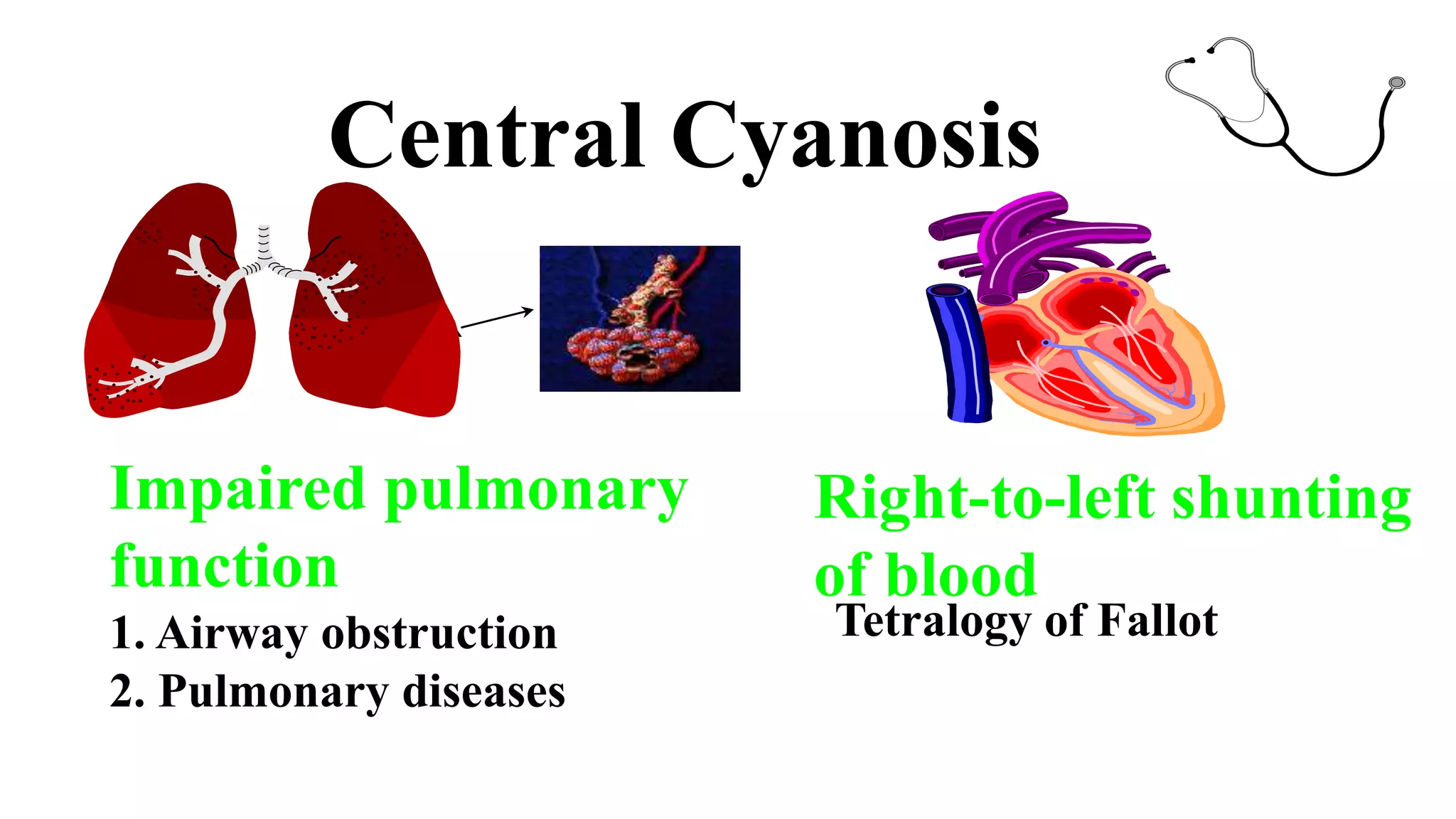 Cyanosis | PPT