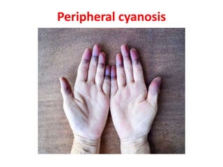 cyanosis.pptx