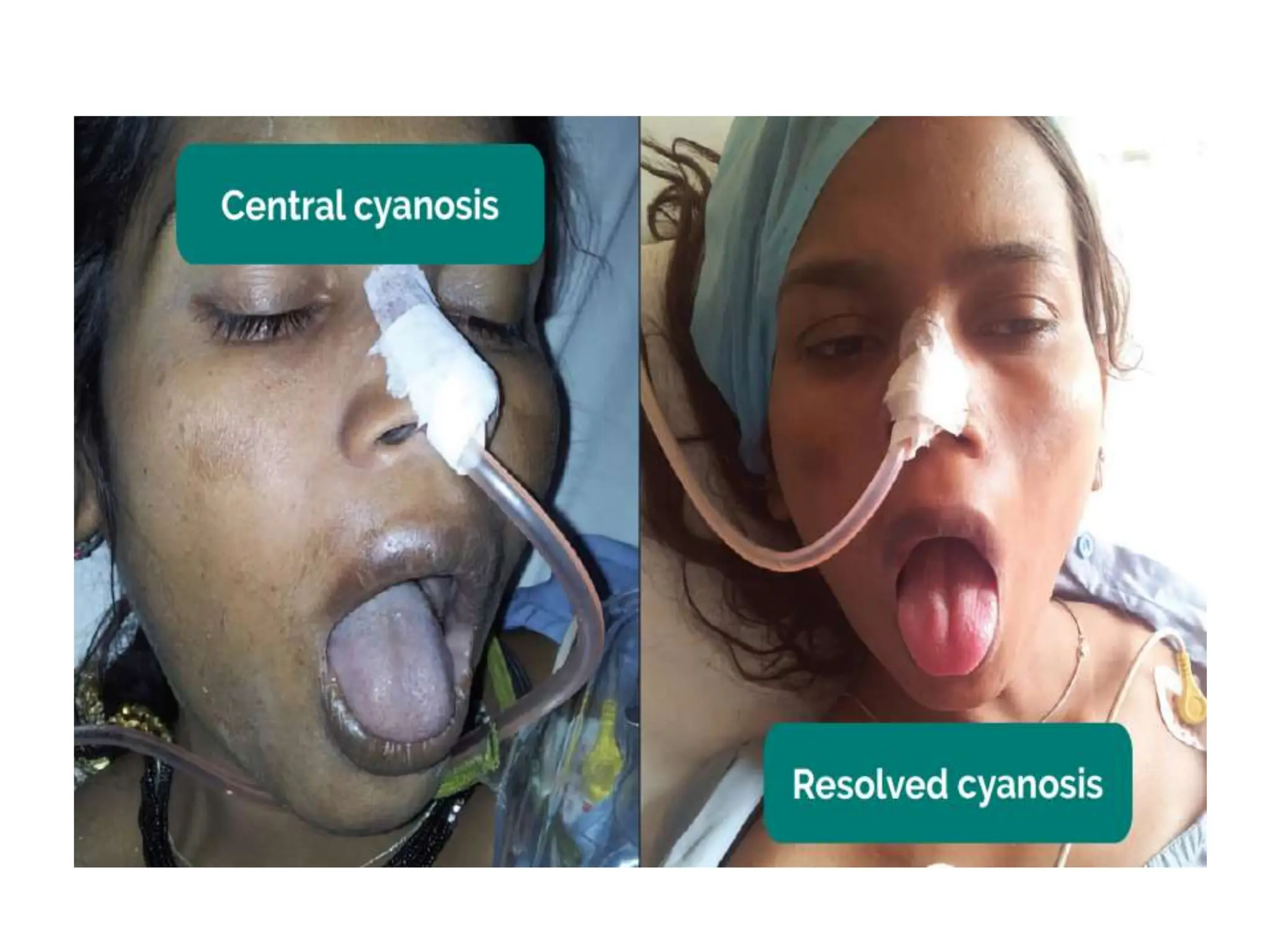 cyanosis.pptx