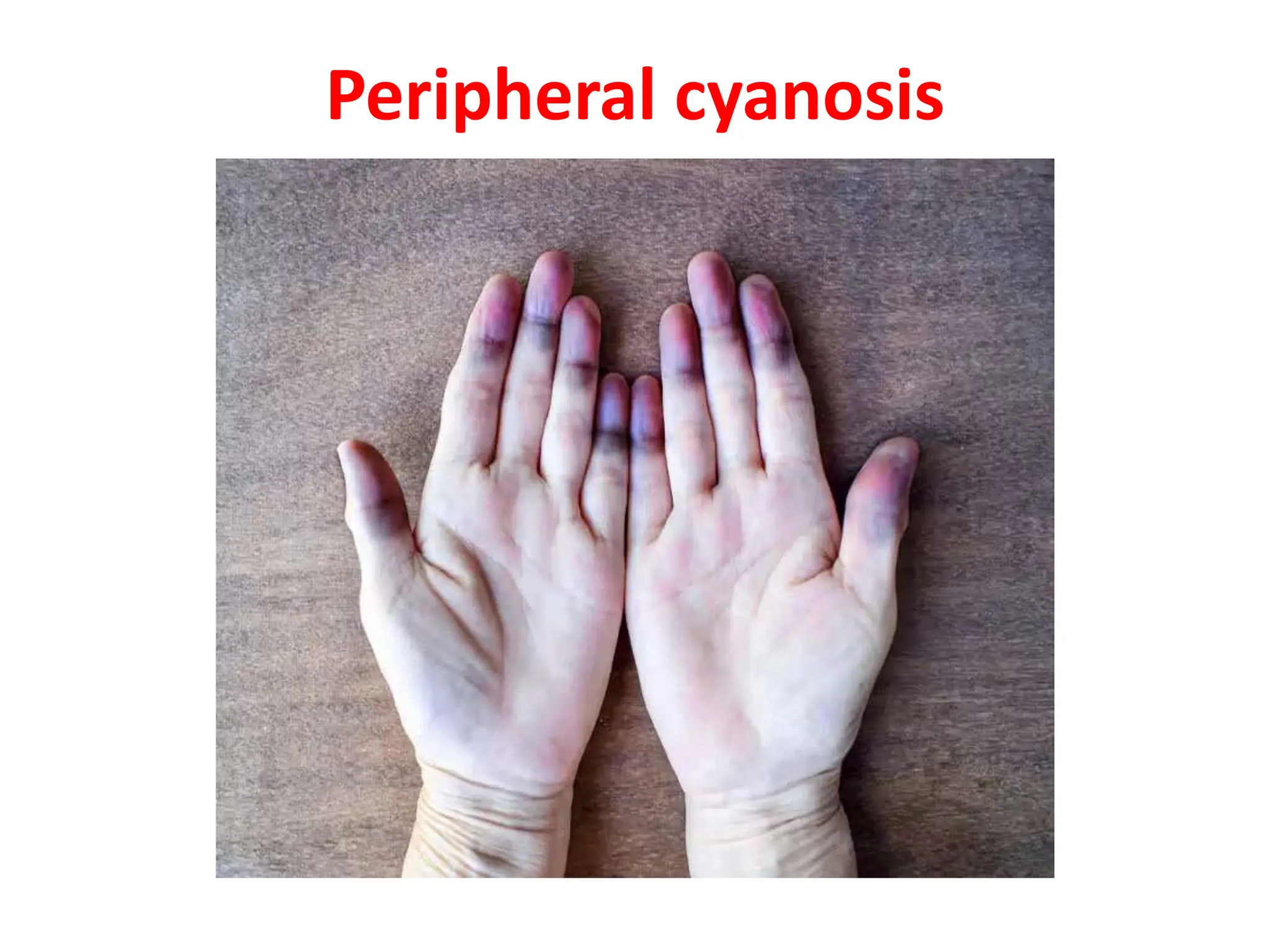 cyanosis.pptx
