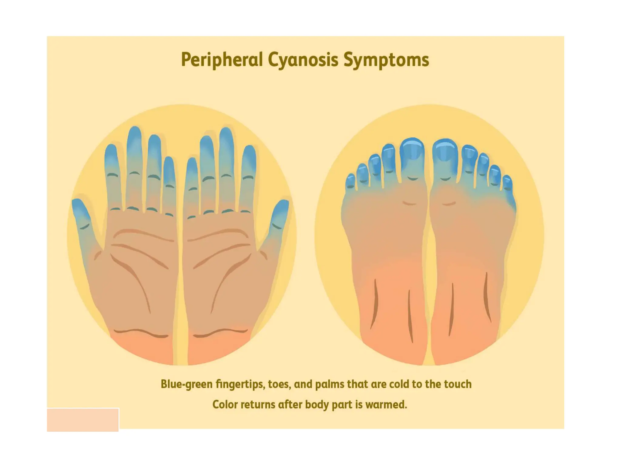 cyanosis.pptx