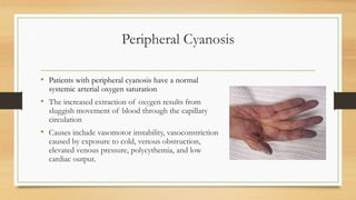 Cyanosis for medical school students.pptx