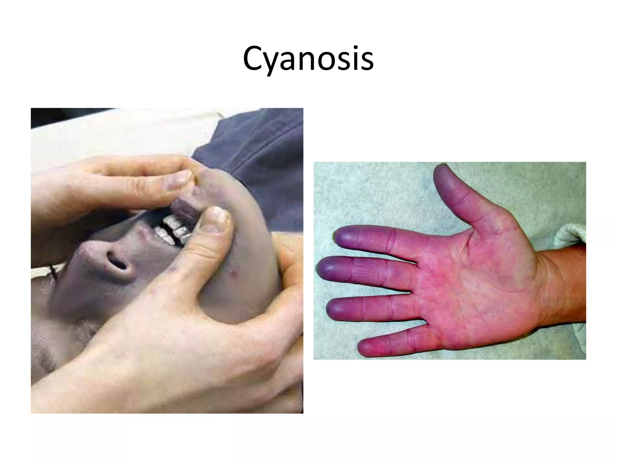 cyanosis_1.pptx