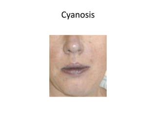 cyanosis_1.pptx