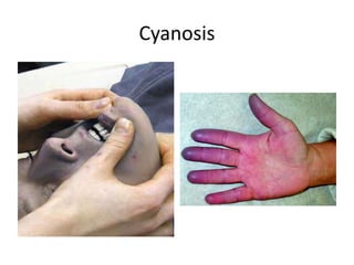 cyanosis_1.pptx